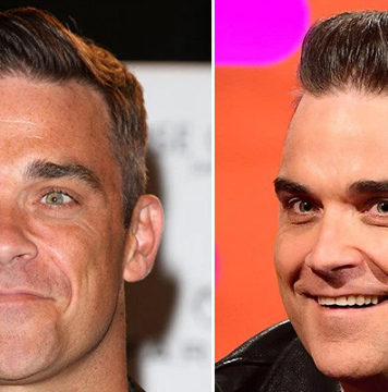 Robbie Williams botox esagerato: non muove più la fronte - Rifatti ...